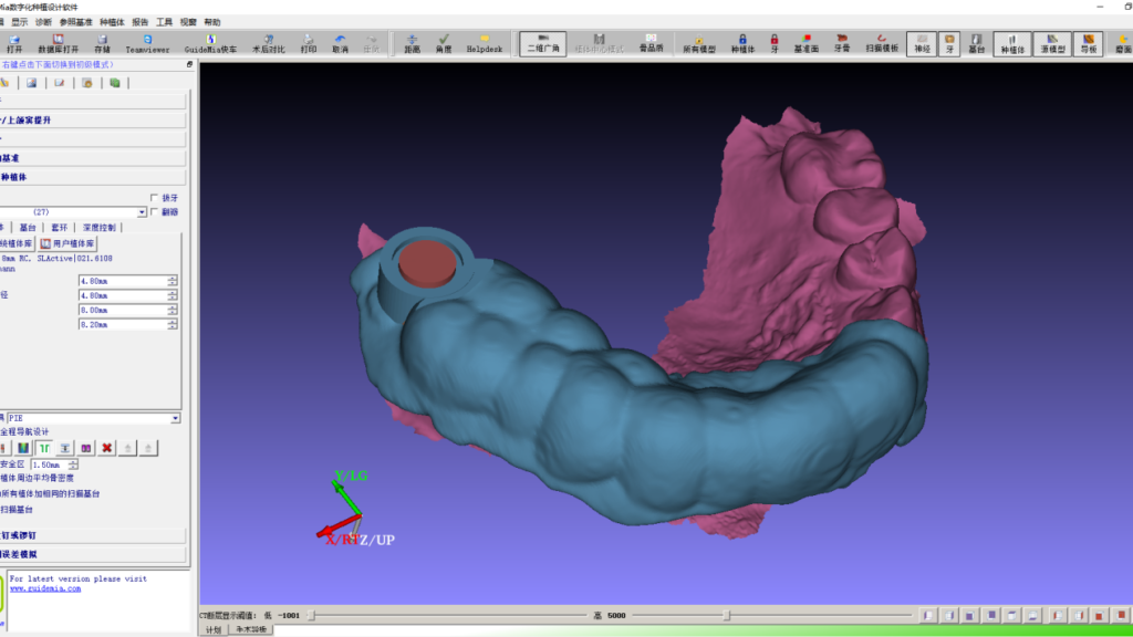 Surgical Guide in Maxillary Sinus Lifting: 3D Scan and Print