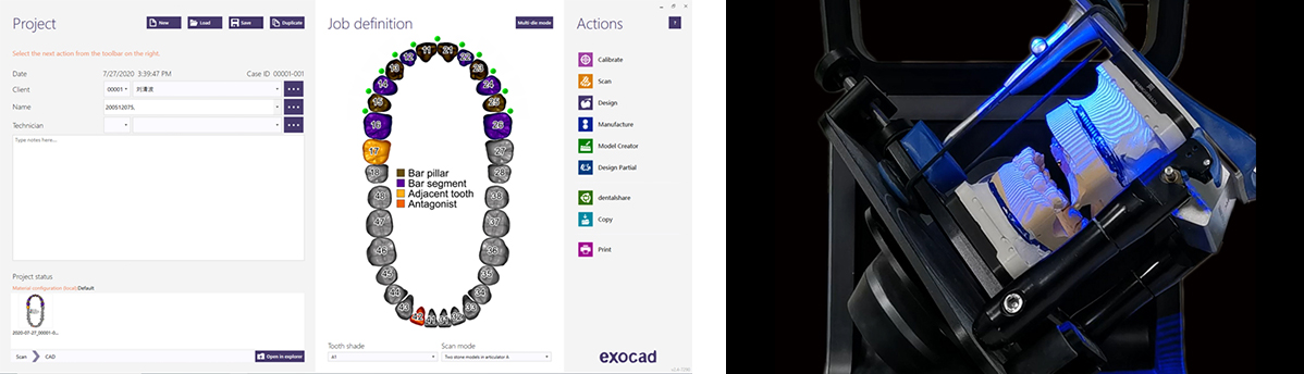 Maxillary Bar Supported Denture with 3D Scanning and Milling
