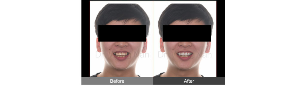 Digital Smile Design Workflow With SHINING 3D Scanners and Printer