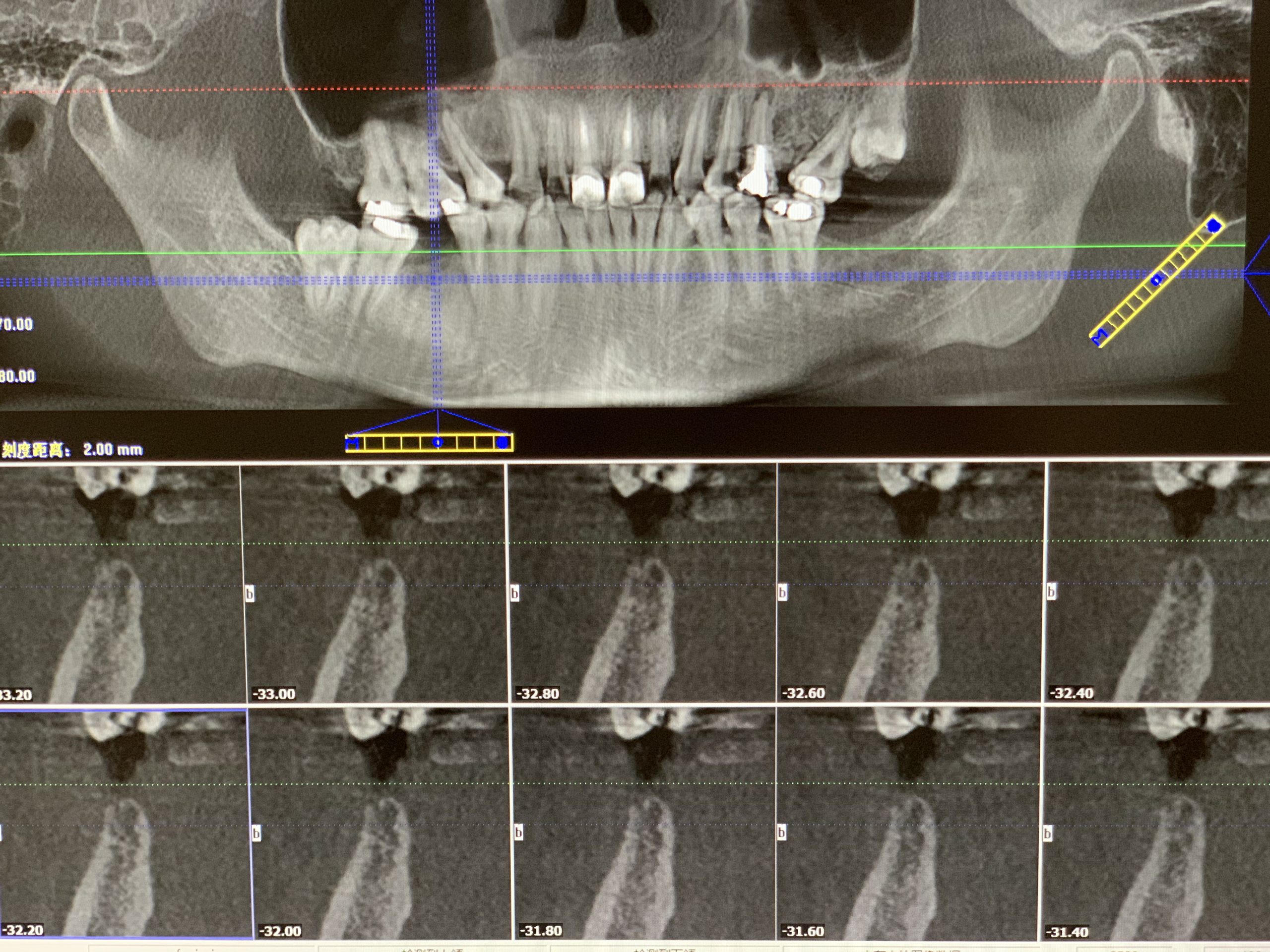 Narrow Diameter Implant in Posterior Mandible: 3D Printed Surgical Guide