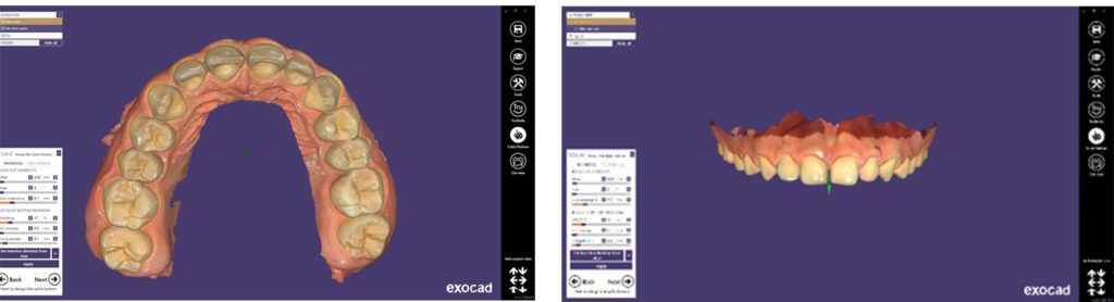Surgical Guide for Crown Lengthening: From 3D Scan to 3D Print