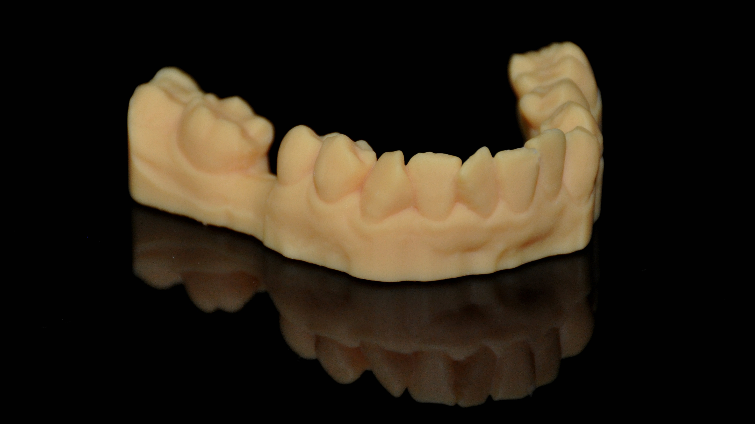 Narrow Diameter Implant in Posterior Mandible - www.shining3ddental.com