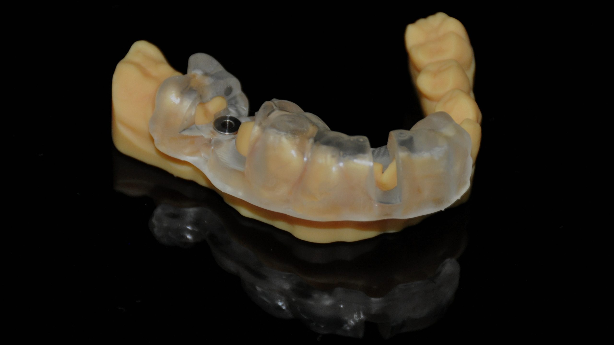 Narrow Diameter Implant in Posterior Mandible: 3D Printed Surgical Guide