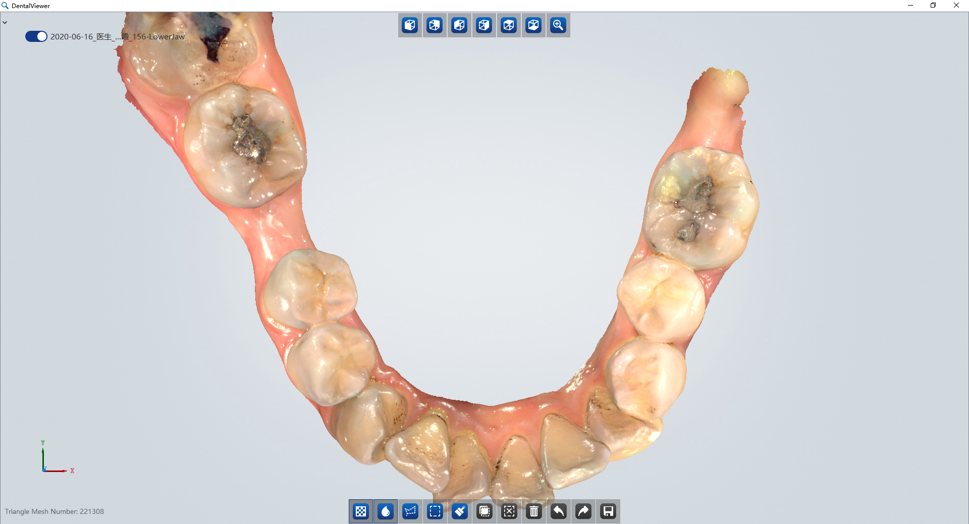 Narrow Diameter Implant in Posterior Mandible: 3D Printed Surgical Guide