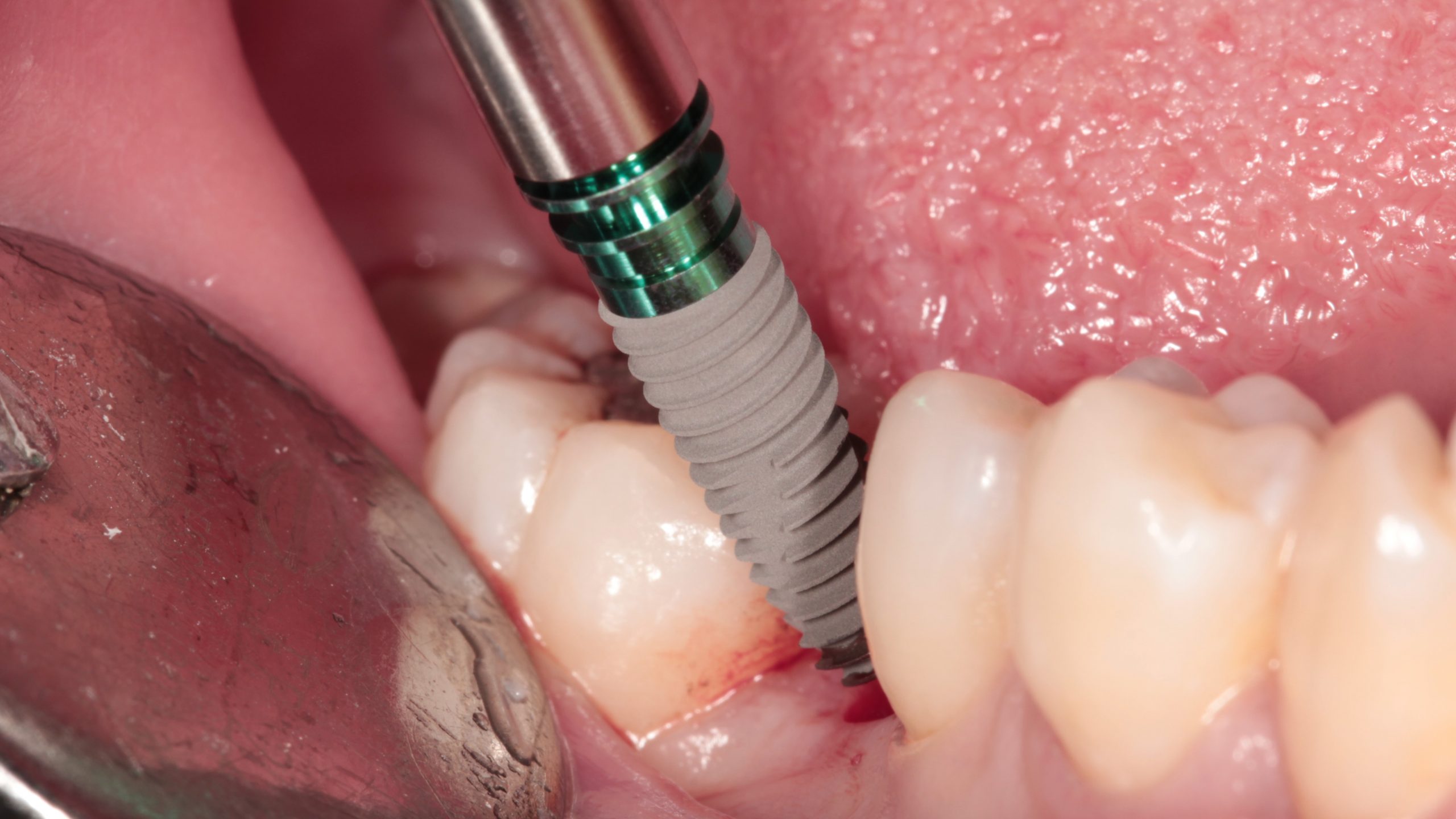 Implantology Between Narrow Posterior Teeth: Digital Dentistry