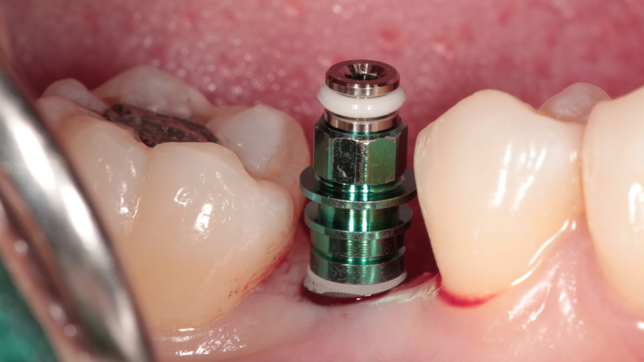 Implantology Between Narrow Posterior Teeth: Digital Dentistry