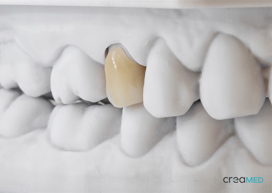 Permanent crown on post and core_CreaMed - shining3ddental.com