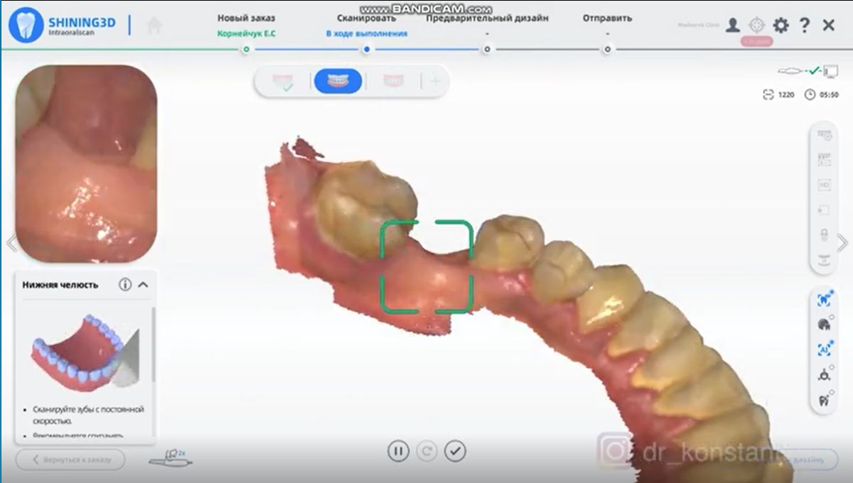 3D Printed Surgical Guide - 3D Scan and 3D Print with SHINING 3D
