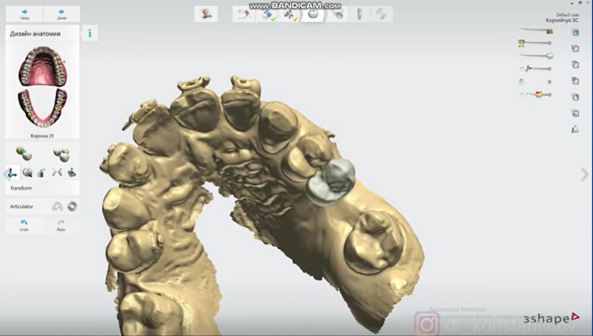 3D Printed Surgical Guide - 3D Scan and 3D Print with SHINING 3D