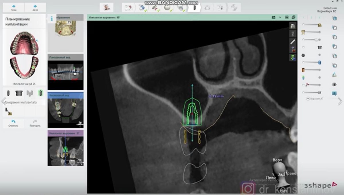 3D Printed Surgical Guide - 3D Scan and 3D Print with SHINING 3D