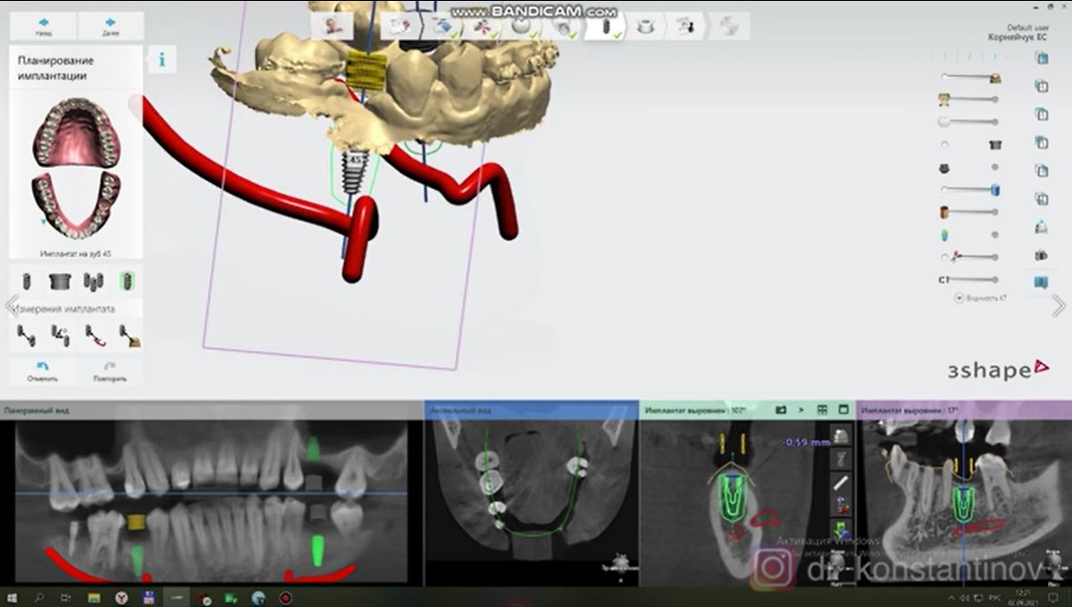 3D Printed Surgical Guide - 3D Scan and 3D Print with SHINING 3D