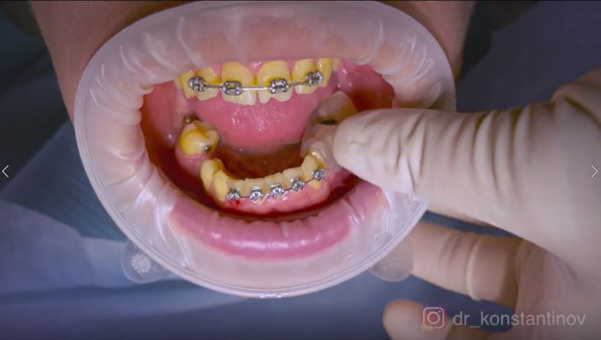 3D Printed Surgical Guide - 3D Scan and 3D Print with SHINING 3D
