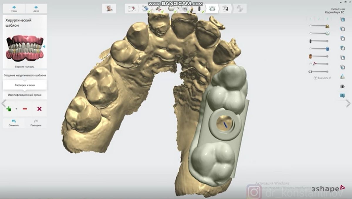 3D Printed Surgical Guide - 3D Scan and 3D Print with SHINING 3D