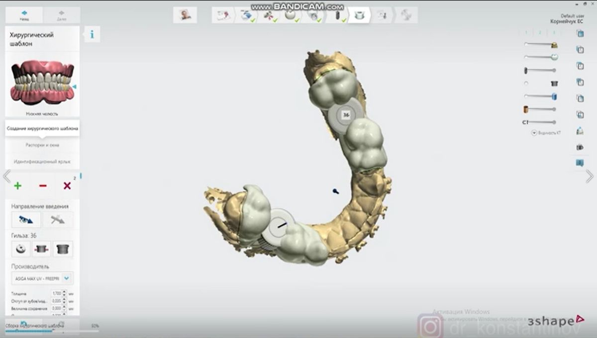 3D Printed Surgical Guide - 3D Scan and 3D Print with SHINING 3D
