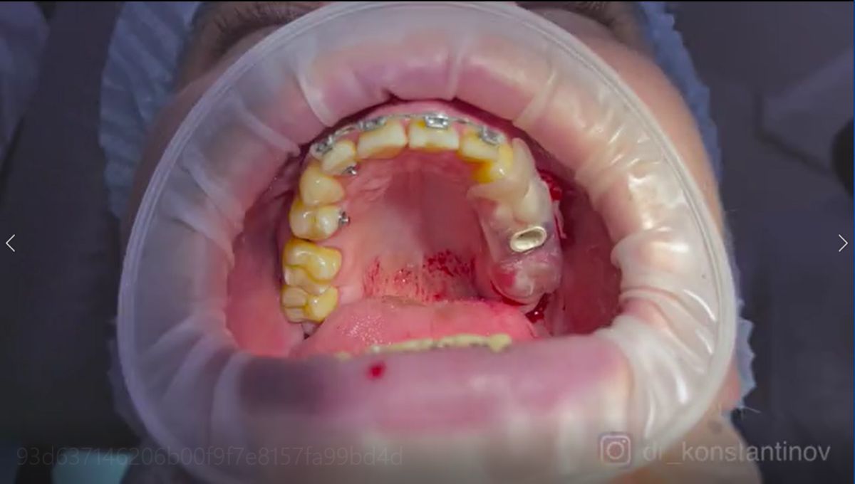 3D Printed Surgical Guide - 3D Scan and 3D Print with SHINING 3D