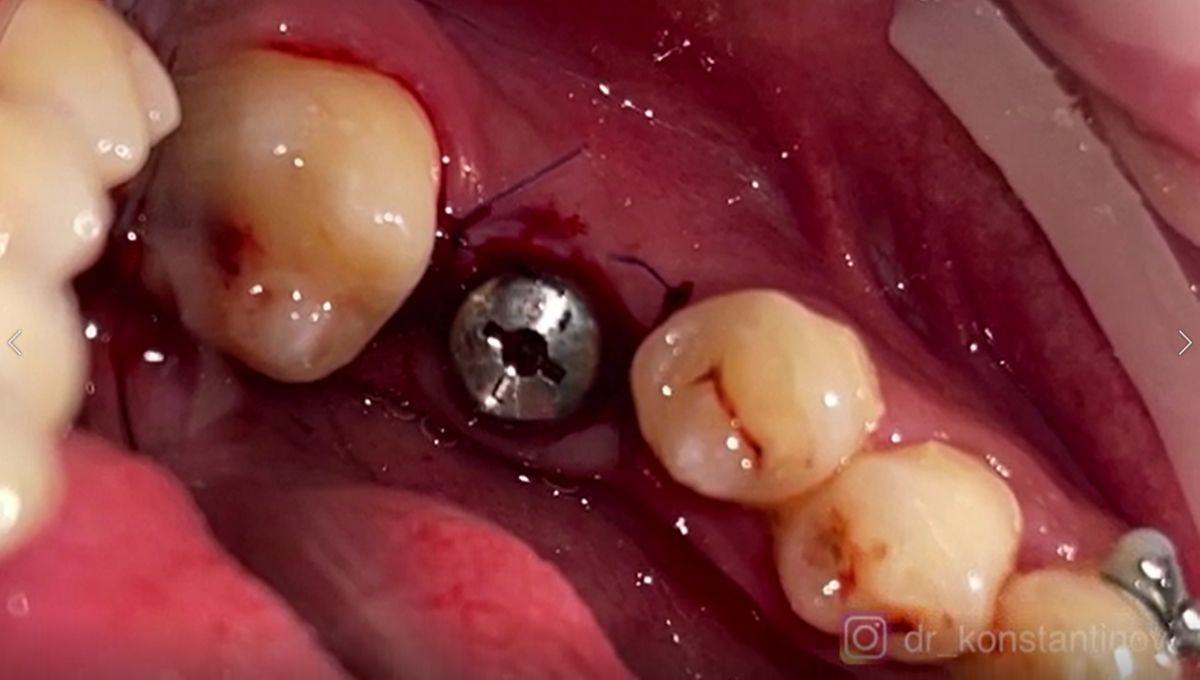 3D Printed Surgical Guide - 3D Scan and 3D Print with SHINING 3D