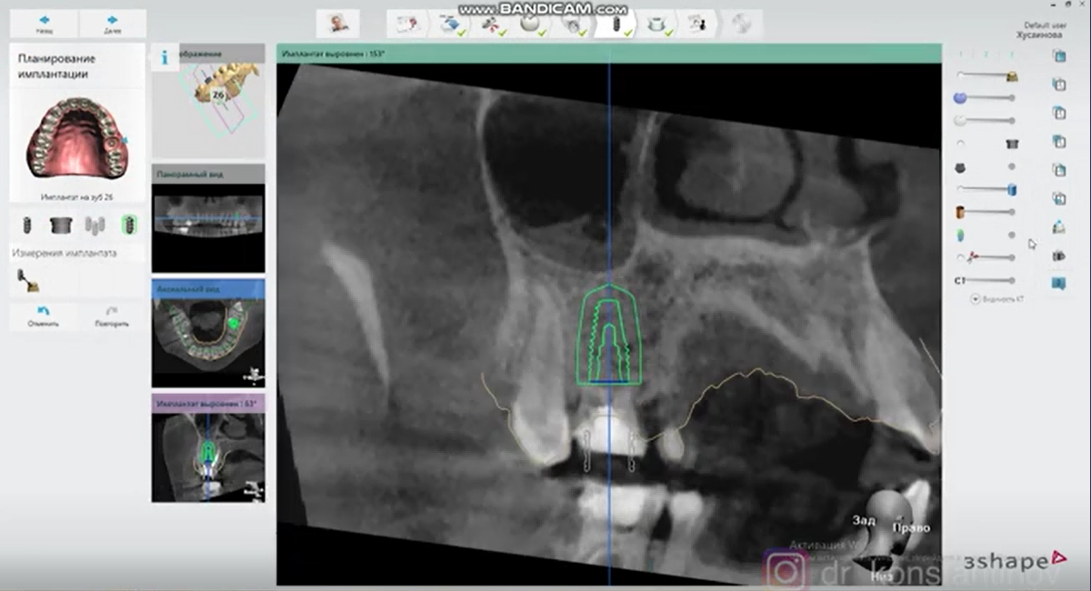 3D Printed Surgical Guide - Digital Dentistry with SHINING 3D Dental