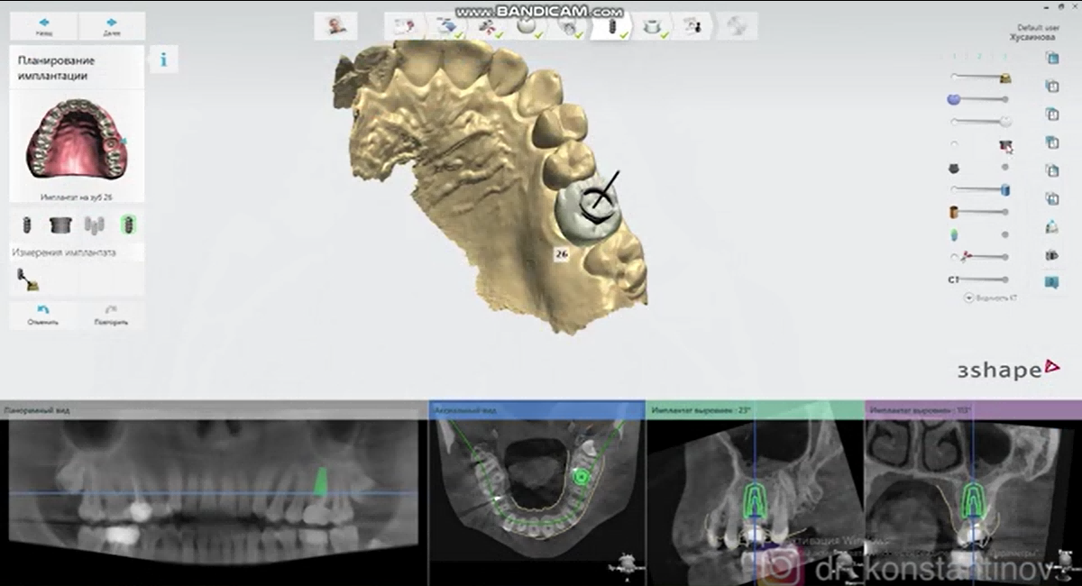 3D Printed Surgical Guide – Fully Guided Implant Surgery