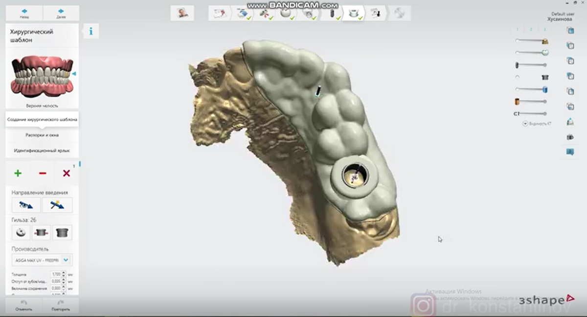 3D Printed Surgical Guide – Fully Guided Implant Surgery