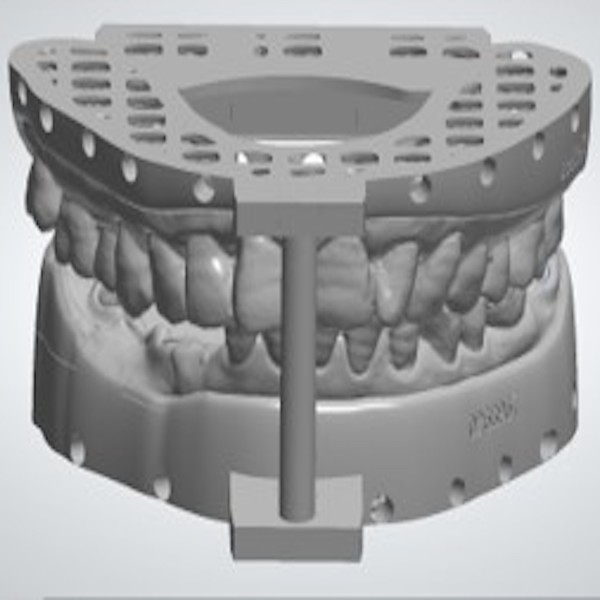 Unilateral distal extension edentulous case with digital dentistry