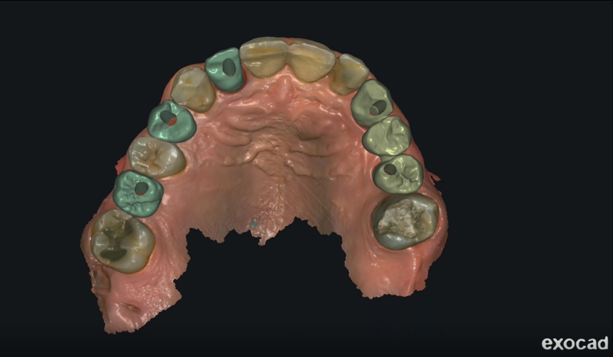 Intraoral scan for multiple implant restoration with Aoralscan 3