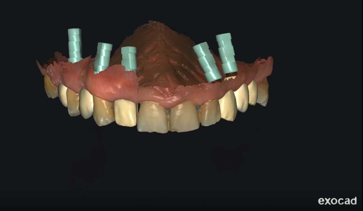 Intraoral scan for multiple implant restoration with Aoralscan 3