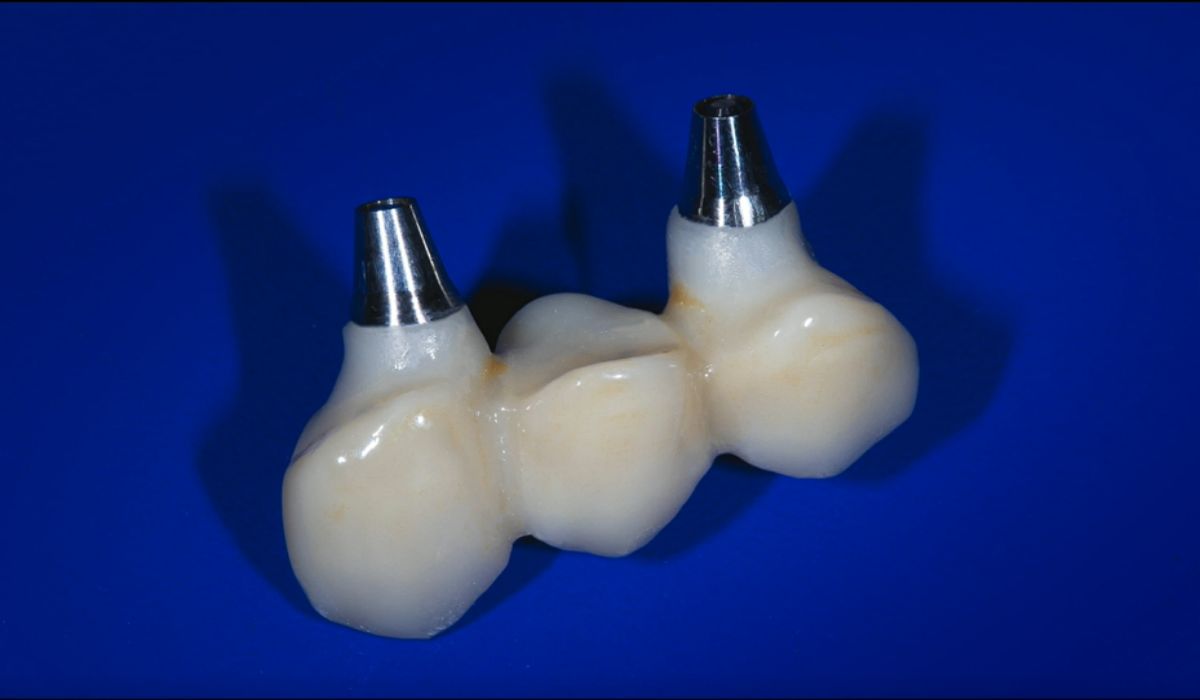 Intraoral scan for multiple implant restoration with Aoralscan 3