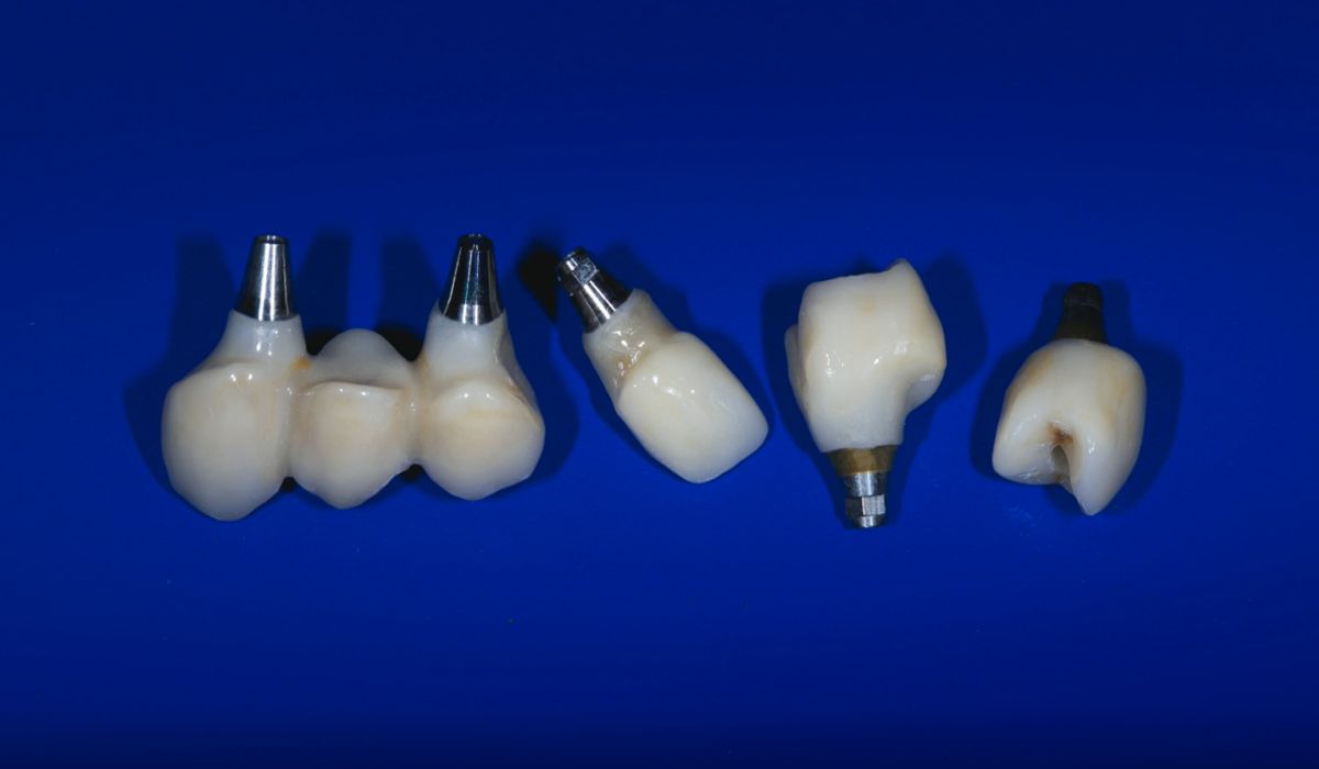 Intraoral scan for multiple implant restoration with Aoralscan 3
