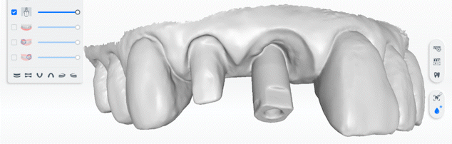 The application of digital technology in immediate implant cases