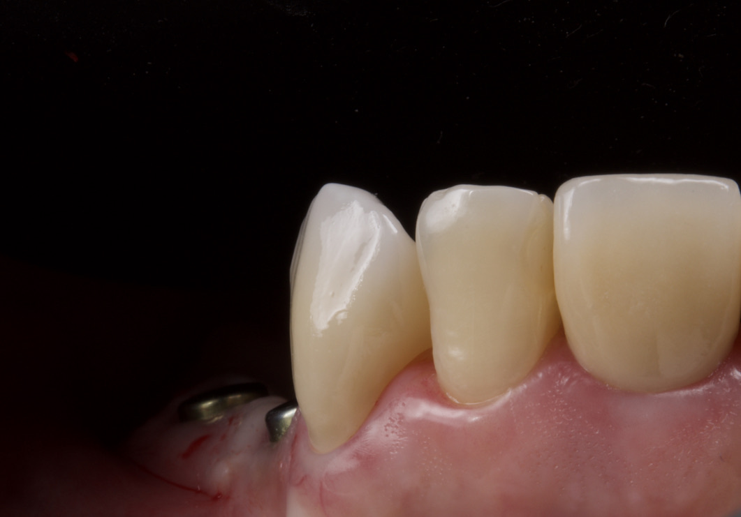 Complete digital workflow for partial oral rehabilitation
