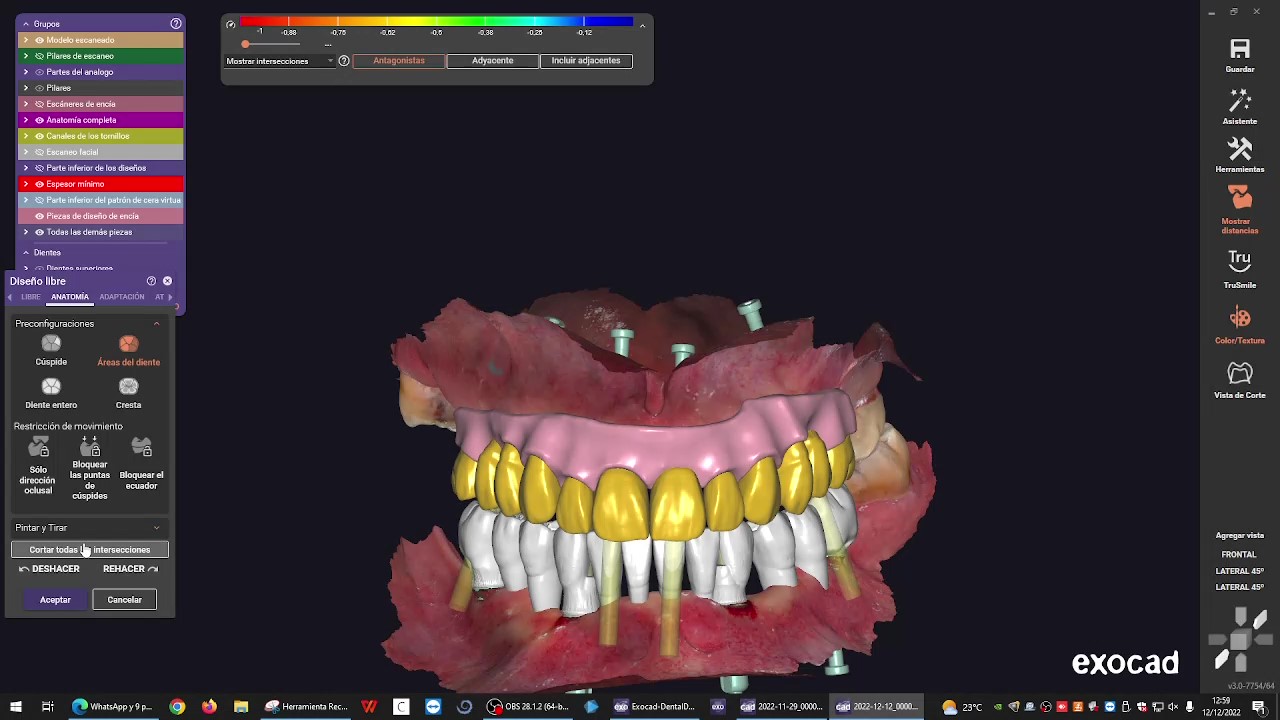 Digital workflow for screw-retained full denture and all-on-4 implants