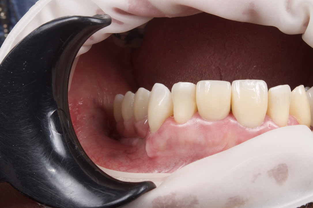 Complete digital workflow for partial oral rehabilitation
