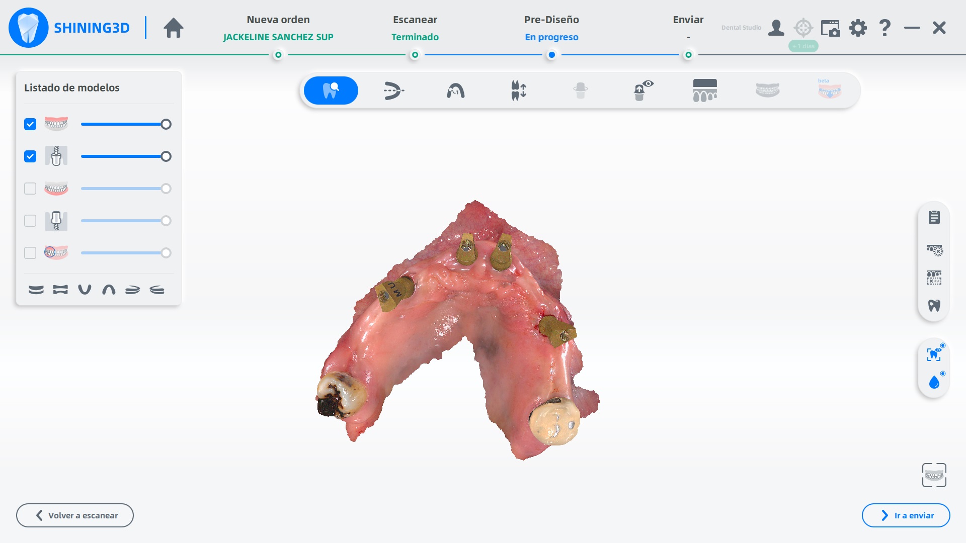 Digital workflow for screw-retained full denture and all-on-4 implants