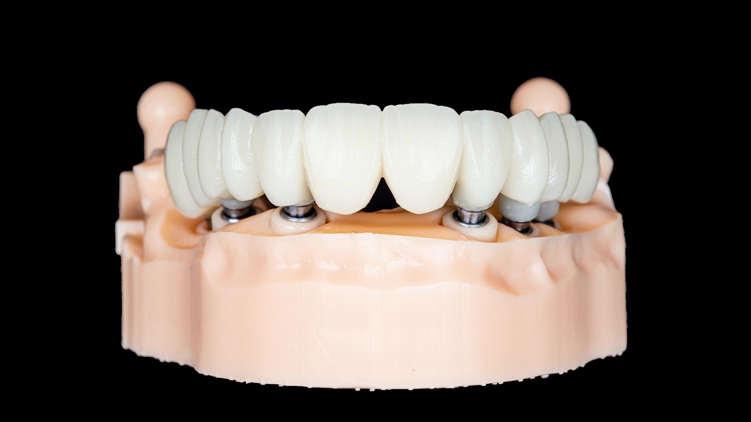 Full mouth occlusion reconstruction using digital technology