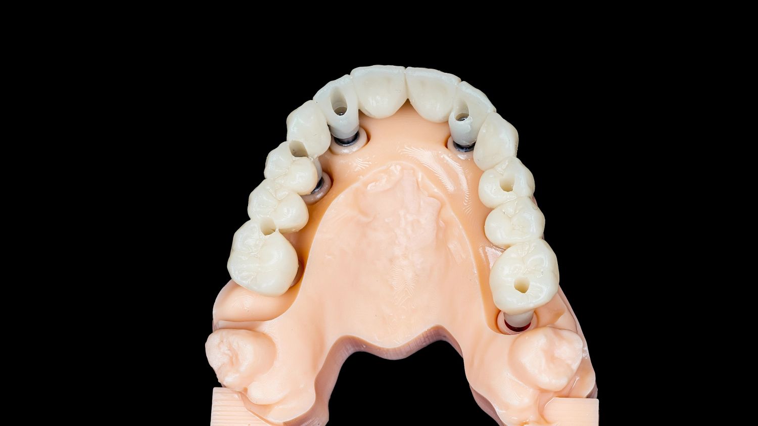 Full mouth occlusion reconstruction using digital technology