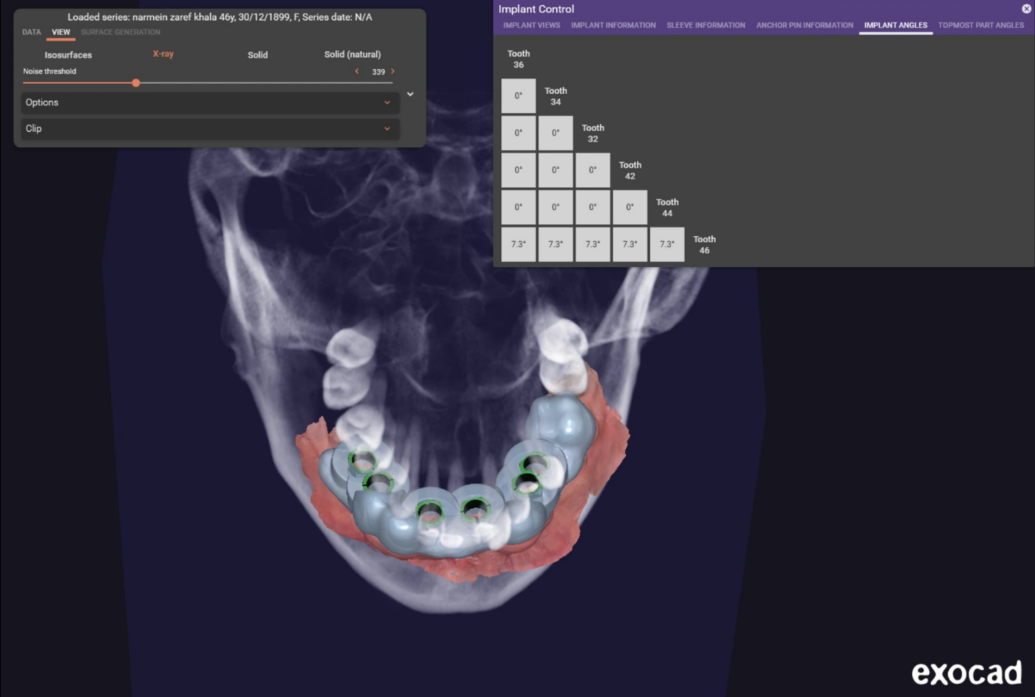 Full mouth occlusion reconstruction using digital technology