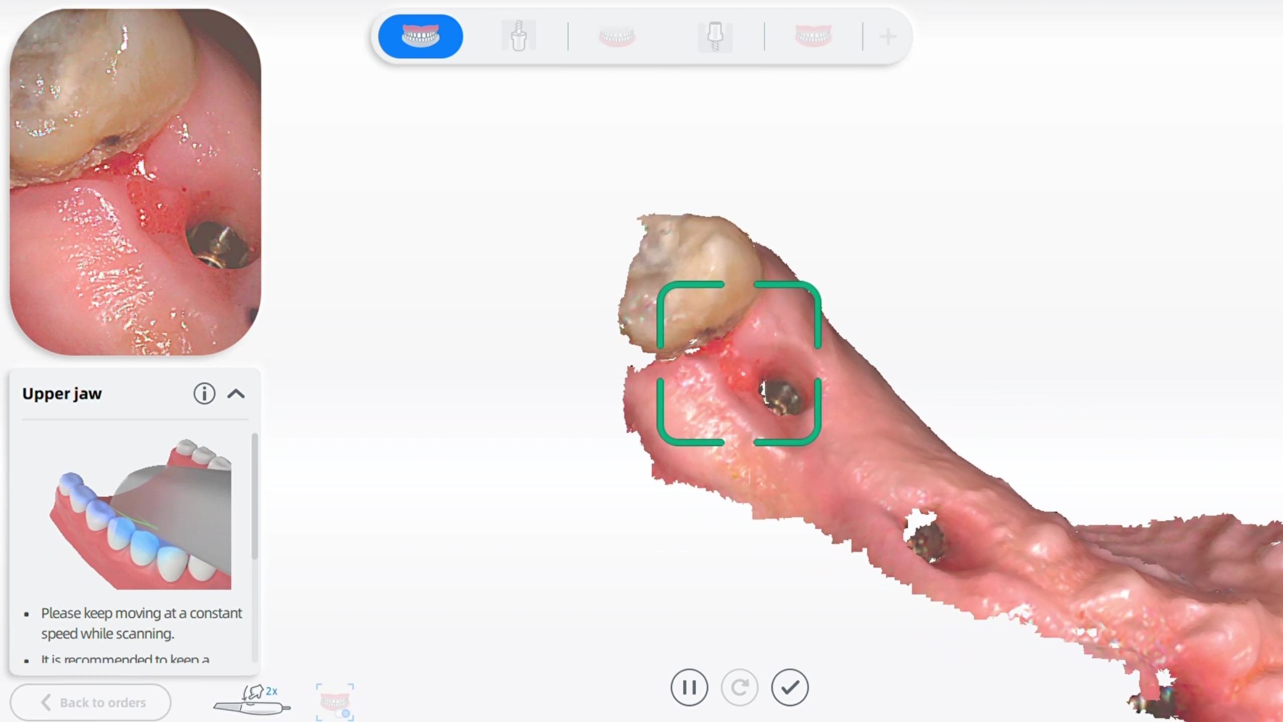 Full mouth occlusion reconstruction using digital technology