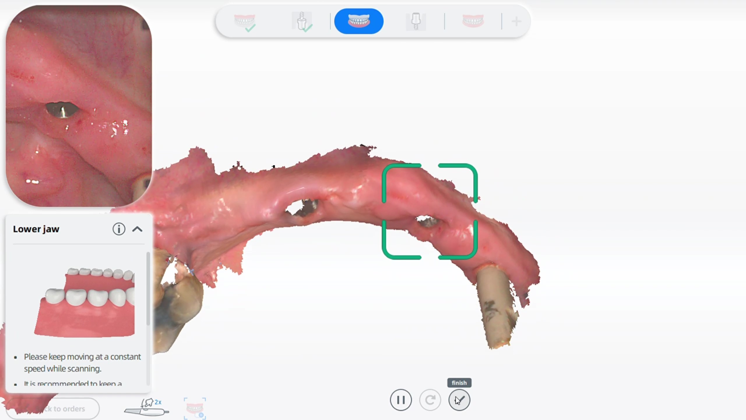 Full mouth occlusion reconstruction using digital technology