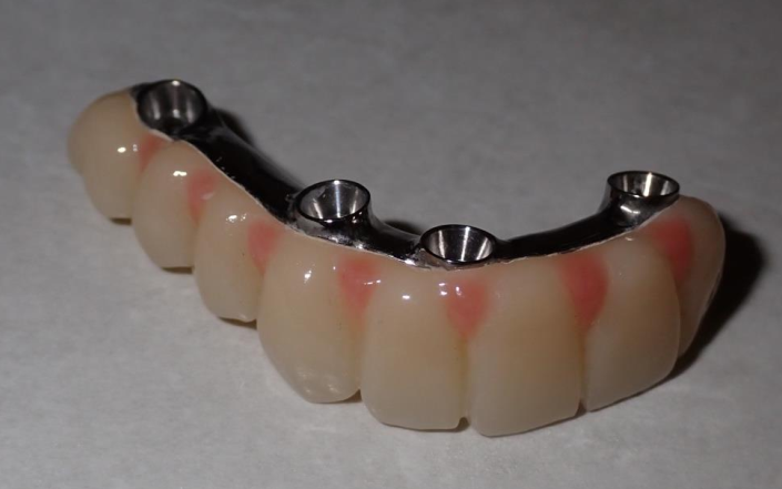 Multiple Implant Restoration with Aoralscan Elite IPG Technology - www ...