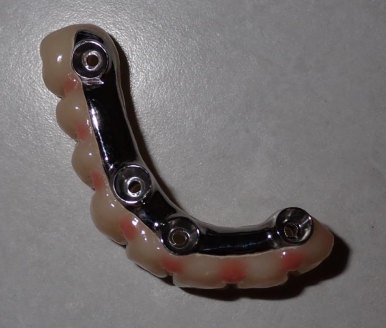 Multiple Implant Restoration with Aoralscan Elite IPG Technology - www ...