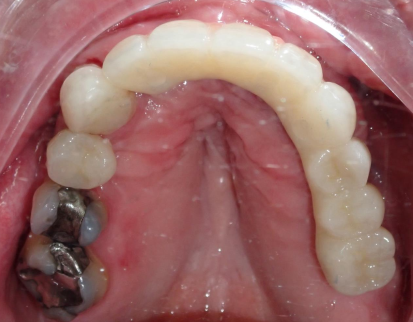 Multiple Implant Restoration with Aoralscan Elite IPG Technology - www ...