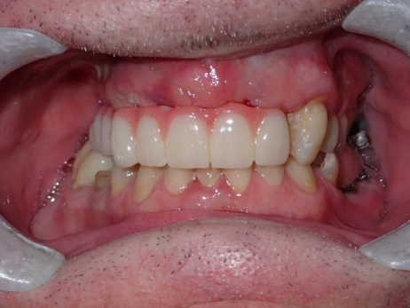 Multiple Implant Restoration with Aoralscan Elite IPG Technology - www ...