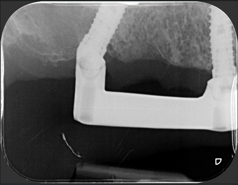 Intraoral Photogrammetry: Is this the end of Plaster impressions? - www ...