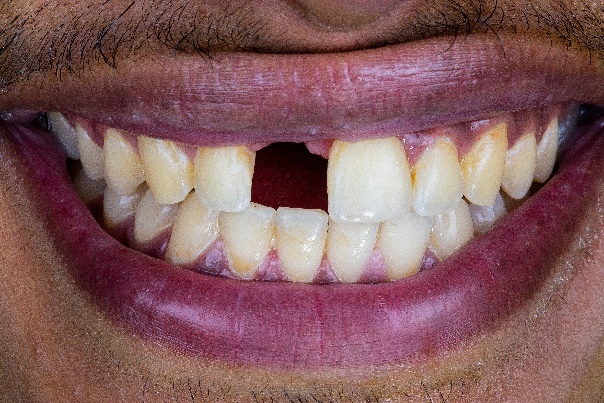 Digital Aesthetic Implant Restoration of Anterior Tooth with Aoralscan ...
