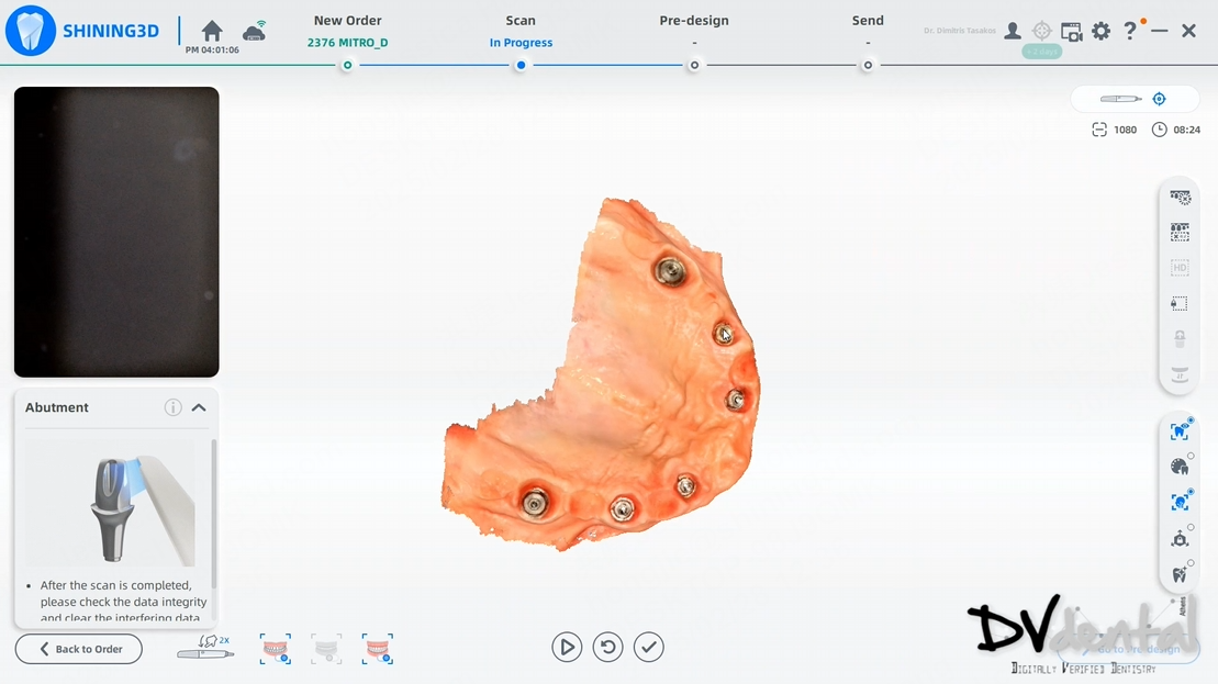 Edentulous Implant-Supported Occlusal Reconstruction Case Using ...