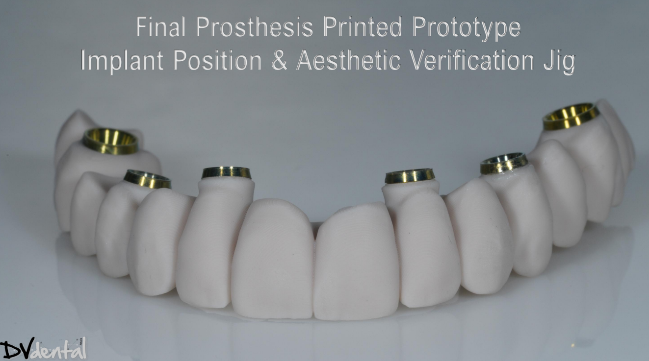 Edentulous Implant-Supported Occlusal Reconstruction Case Using ...