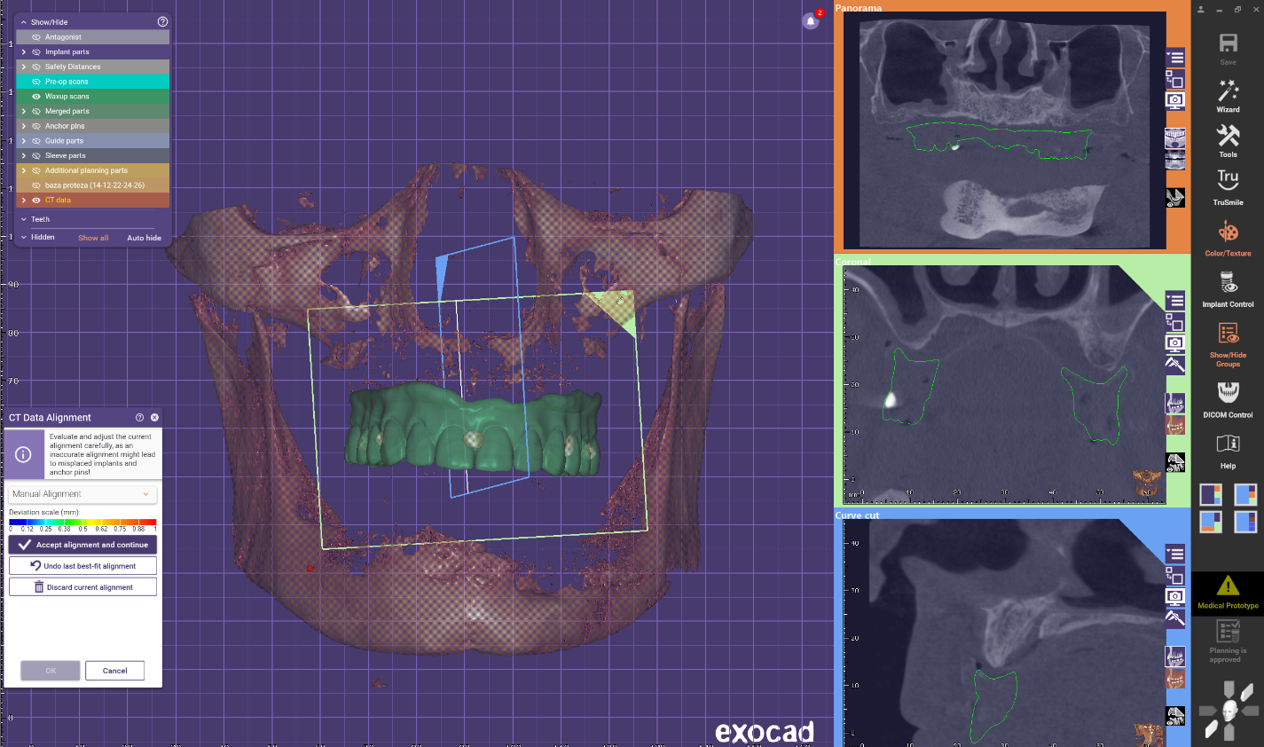 All-on-X Procedure: A Comprehensive Case Study